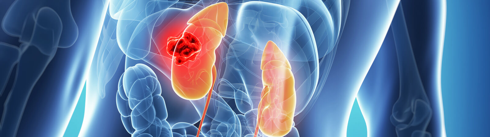 Acute Kidney Injury